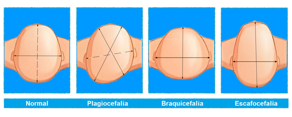 Ortesis craneales en bebés | Ortopedia Juan Bravo Madrid